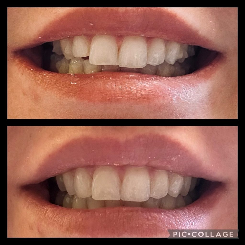 Invisalign